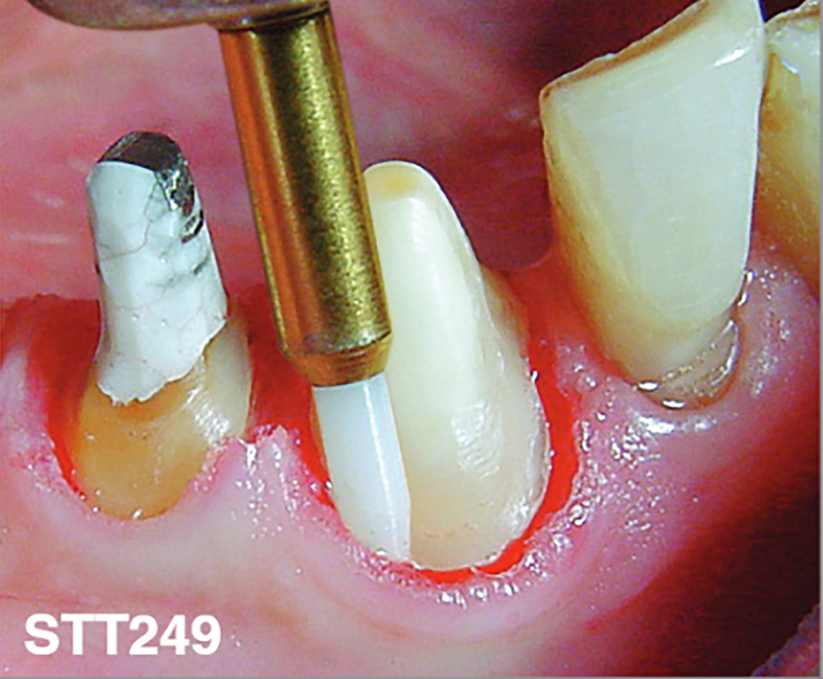 Soft Tissue Trimmer - Confi-dent Clinical - Edenta South Africa – Confi ...